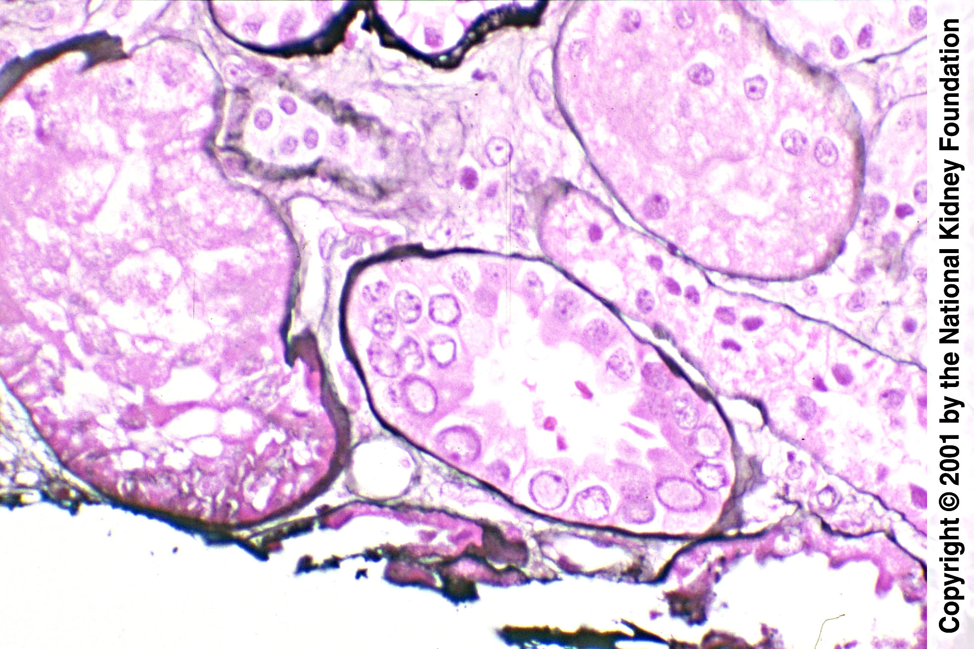 Virus Bk Polyomavirus BK Polyomavirus BK Humano BK Polyomavirus Virus Bk Polyomavirus BK Polyomavirus BK Humano BK Polyomavirus